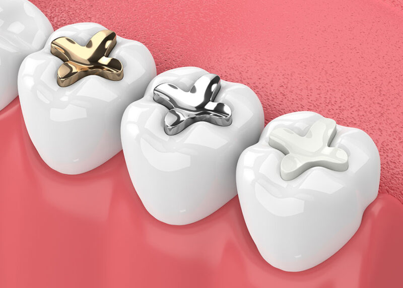 How Long Do Dental Fillings Last? | Premier Cosmetic Dentistry
